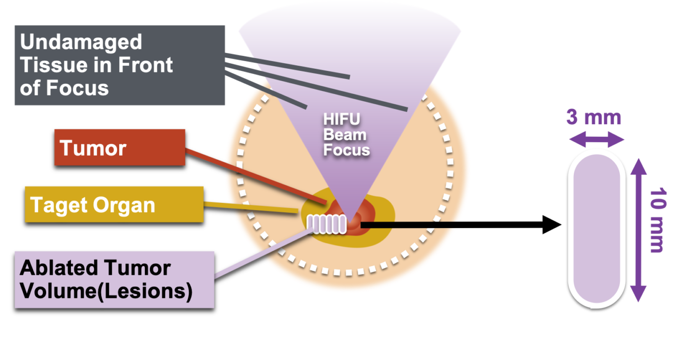 HIFU - High-Intensity Focused Ultrasound Therapy | Saisei Immunotherapy ...